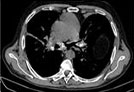 Coexistence of Sarcoidosis and Silicosis: Case Series